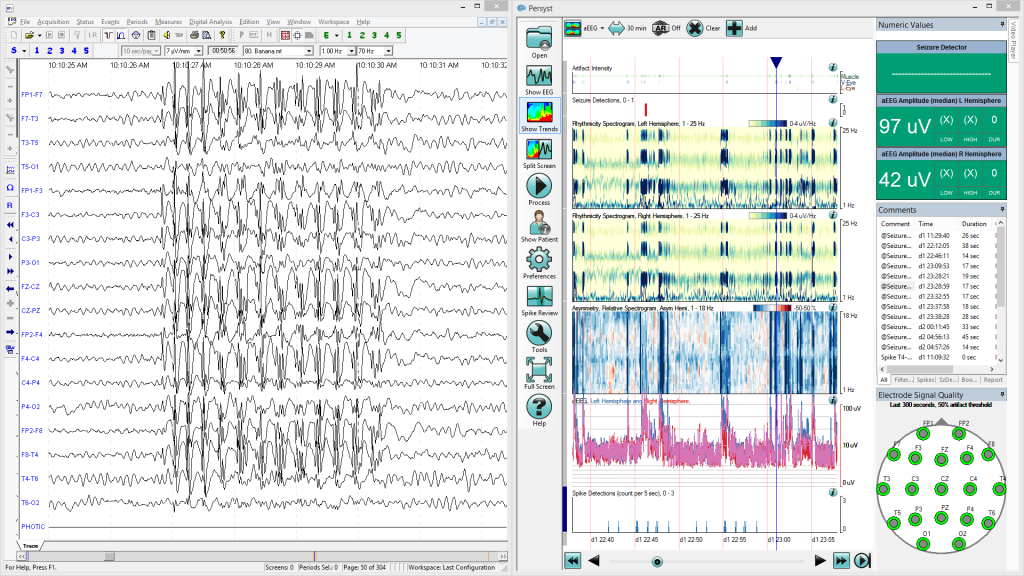 Neurovirtual / Sleepvirtual BWAnalysis EEG/ICU/LTM Software
