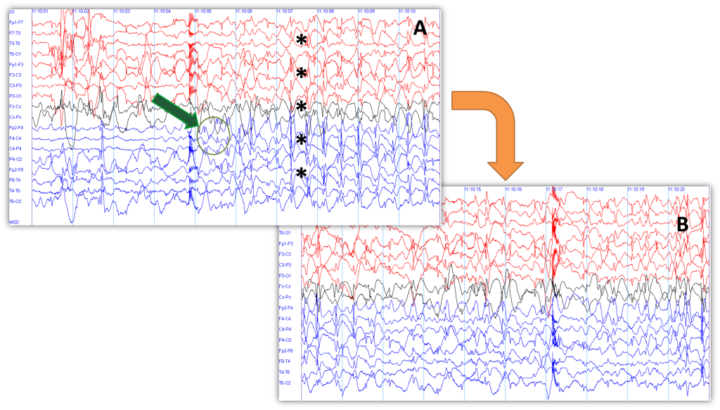 Neurovirtual Lennox-Gastaut syndrome al synchrony as an EEG pitfall ...